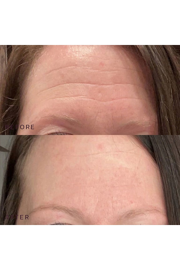 Dermaclara Forehead Occlusion Patch | REVOLVE